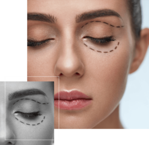 Revision Eyelid Surgery | Leyngold Institute for Plastic Surgery